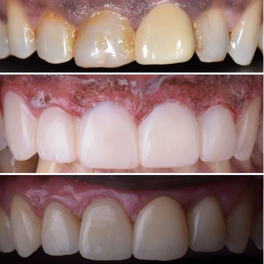 Gum Treatment - Artista Advanced Dentistry
