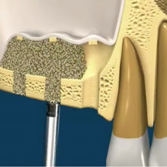 Bone Graft and Sinus Lift - Artista Advanced Dentistry
