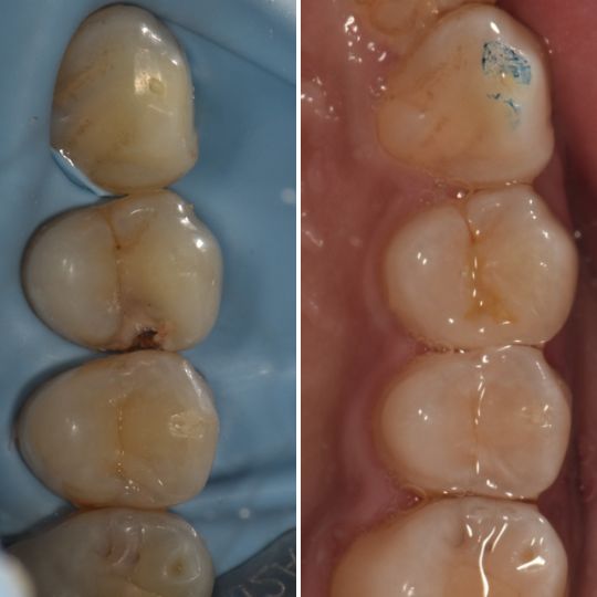 Tooth Colored Fillings - Artista Advanced Dentistry