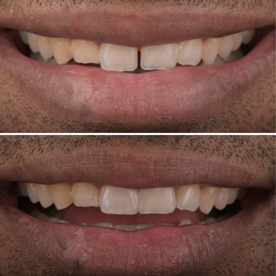 Tooth Colored Fillings - Artista Advanced Dentistry