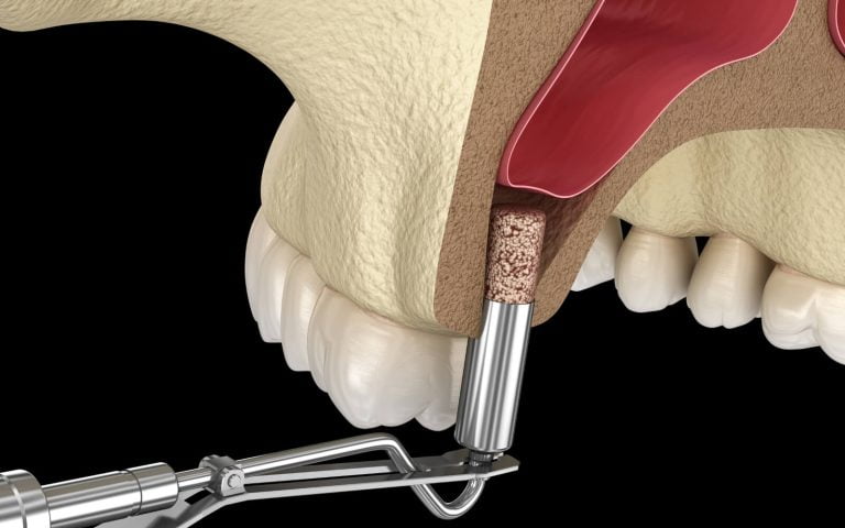 Bone Graft and Sinus Lift - Artista Advanced Dentistry