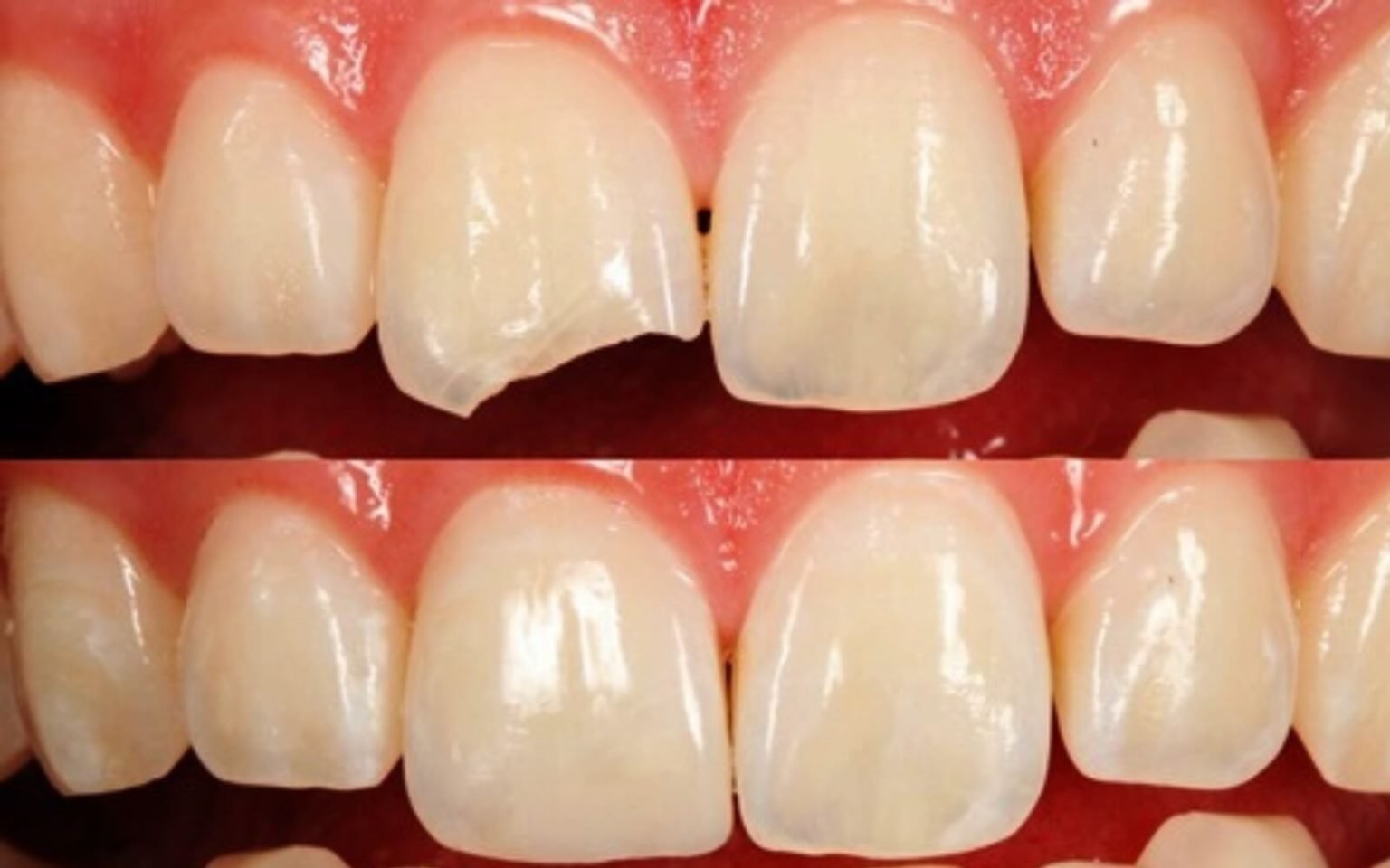 Tooth Colored Fillings - Artista Advanced Dentistry