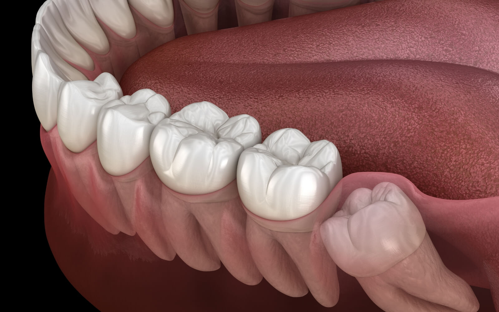 Wisdom Molar Removal - Artista Advanced Dentistry